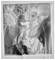 Extensive Recurrent Vesicourethral-Cutaneous Fistula Tracking to the ...