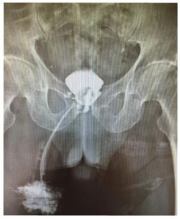 Extensive Recurrent Vesicourethral-Cutaneous Fistula Tracking to the ...