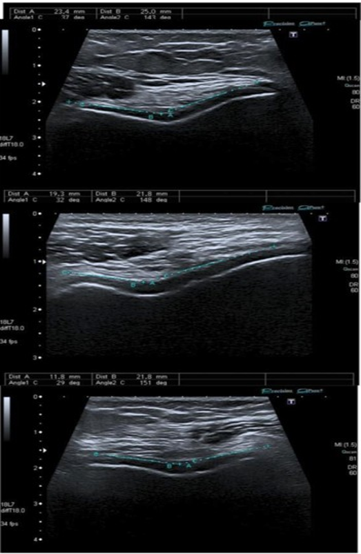 Correlation Between the Cartilage Angle of the Superior Part of the ...