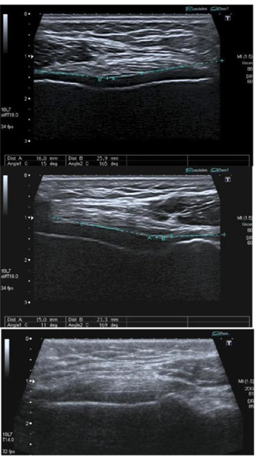 Correlation Between the Cartilage Angle of the Superior Part of the ...
