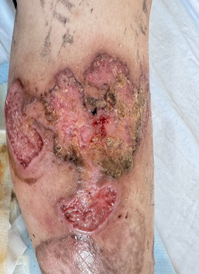 A Unique Treatment for Recurrent Lower Limb Cellulitis Rash and Ulcer ...