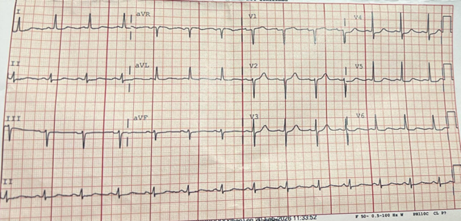 Eosinophilic Granulomatosis with Polyangiitis Presenting with Cardiac ...